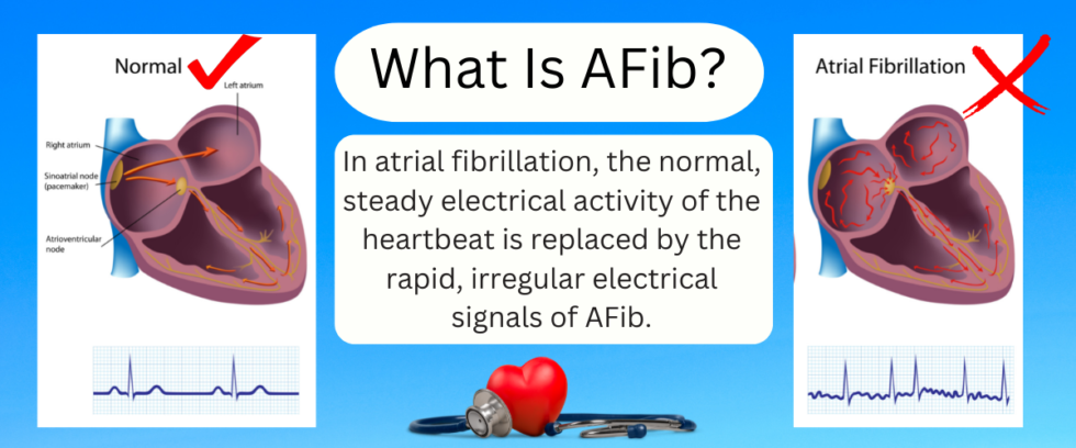 A Comprehensive Guide to Managing Atrial Fibrillation (Mastering the ...